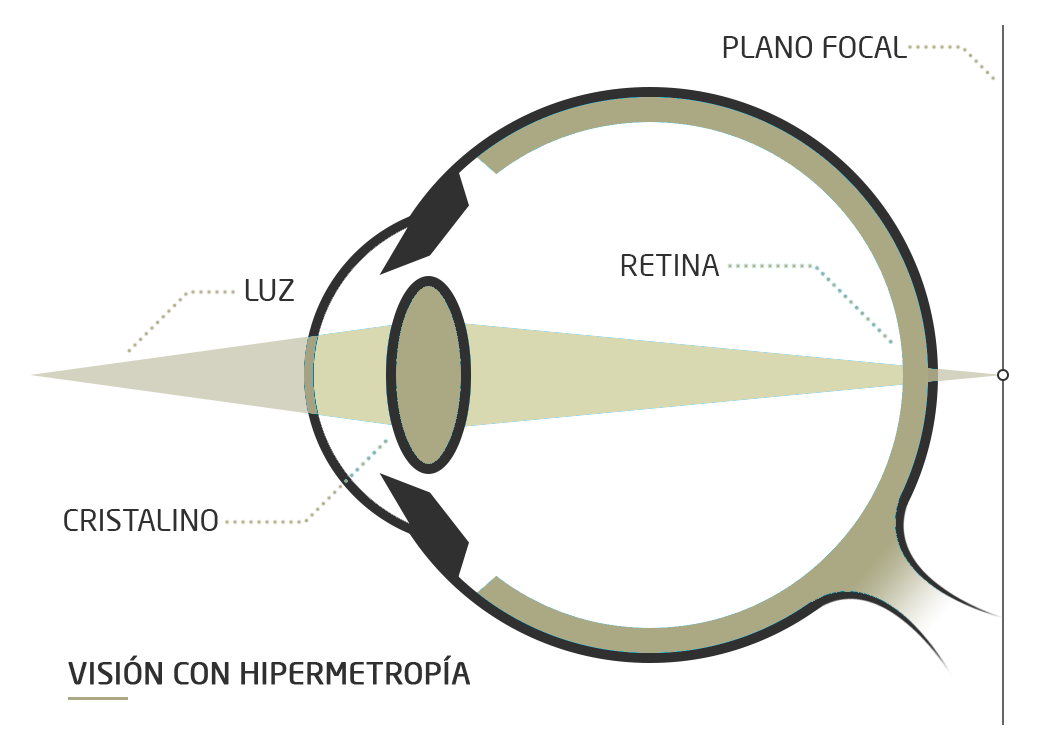 Hipermetropía | Qué es y tratamiento - Clínica Rahhal Valencia